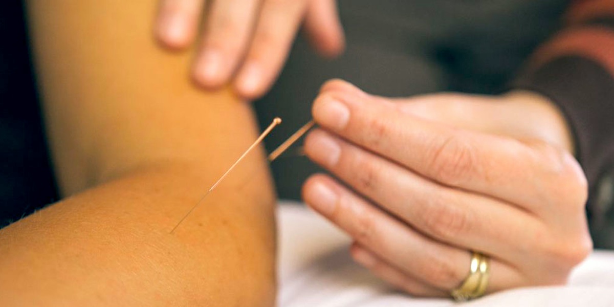 Acupuncture & IMS Richmond | Richmond Blundell Physiotherapy & Sports ...